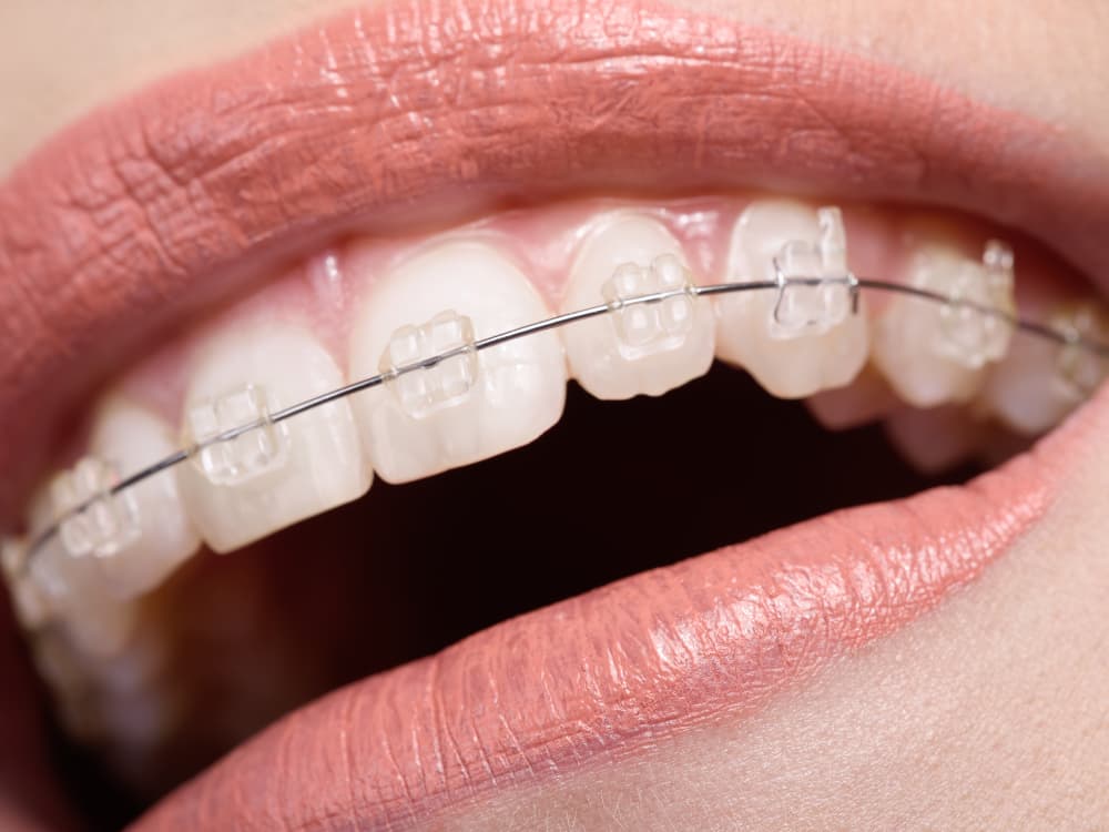 Você sabe qual é a cor mais bonita do aparelho de dente?